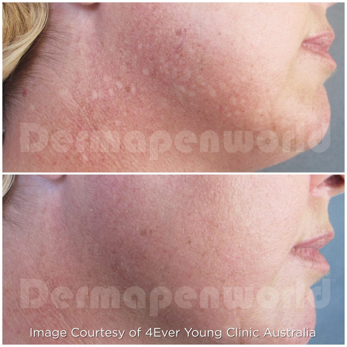 Microneedling Treatment With Dermapen 4 - The Beauty Hub Clinic
